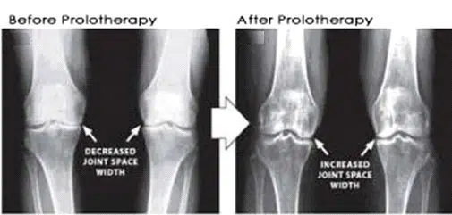 Optimum Care - prolotherapy-before-and-after